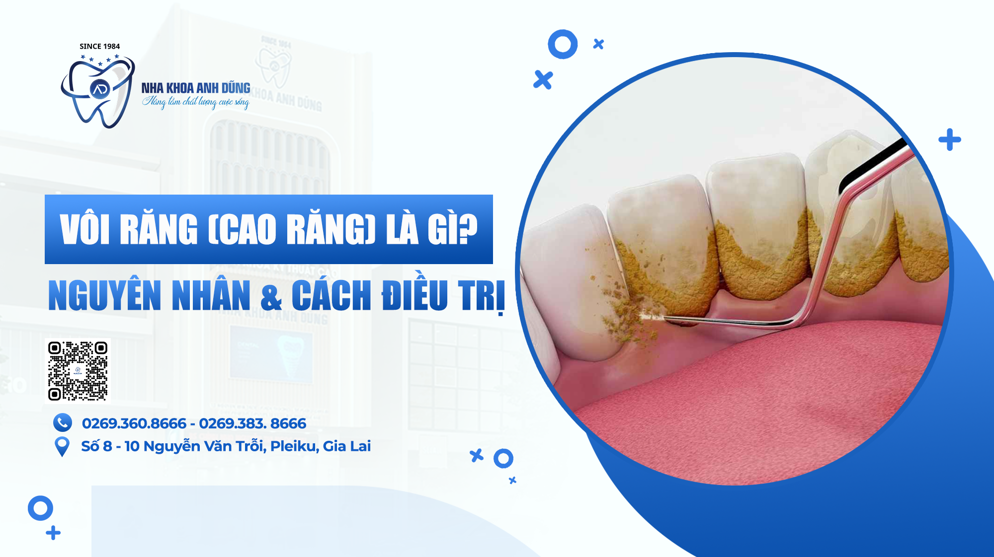 VÔI RĂNG (CAO RĂNG) LÀ GÌ? NGUYÊN NHÂN VÀ CÁCH ĐIỀU TRỊ - Nha Khoa Anh ...