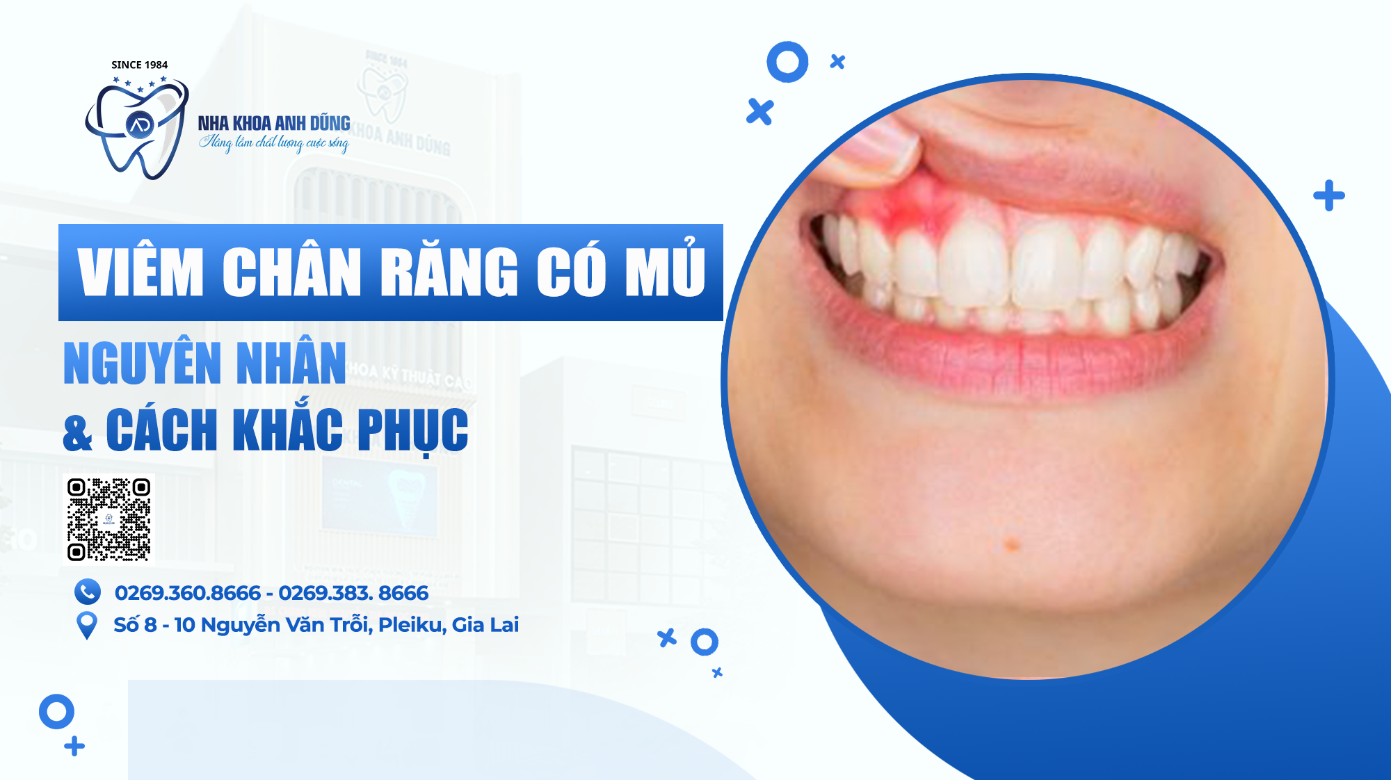 VIÊM CHÂN RĂNG CÓ MỦ - NGUYÊN NHÂN VÀ CÁCH KHẮC PHỤC